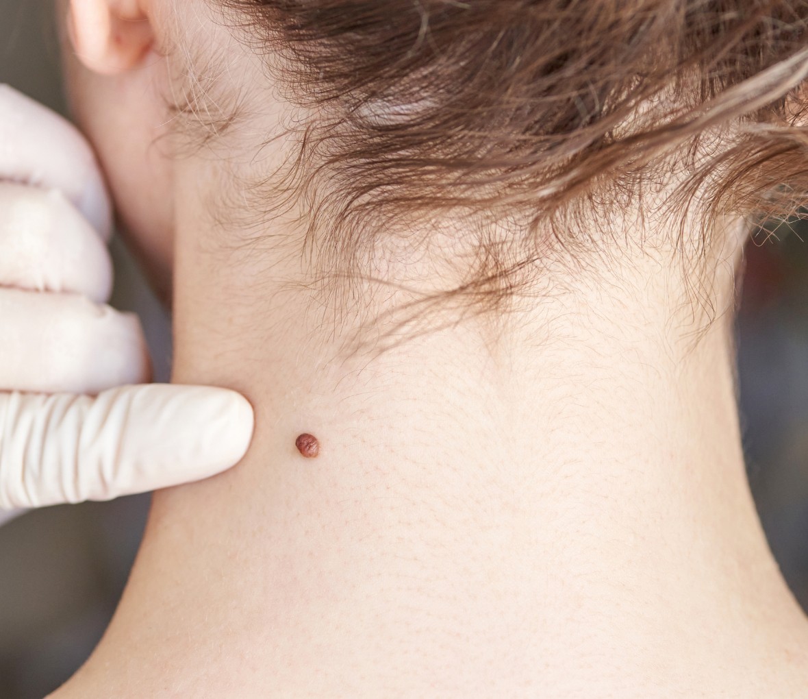 Cosmetic Mole Removal in Aurora | Smooth & Seamless Results